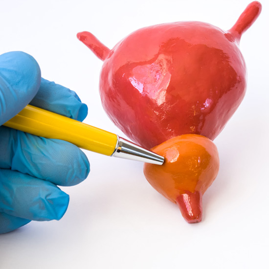 Biopsia prostaty - Rakovina prostaty